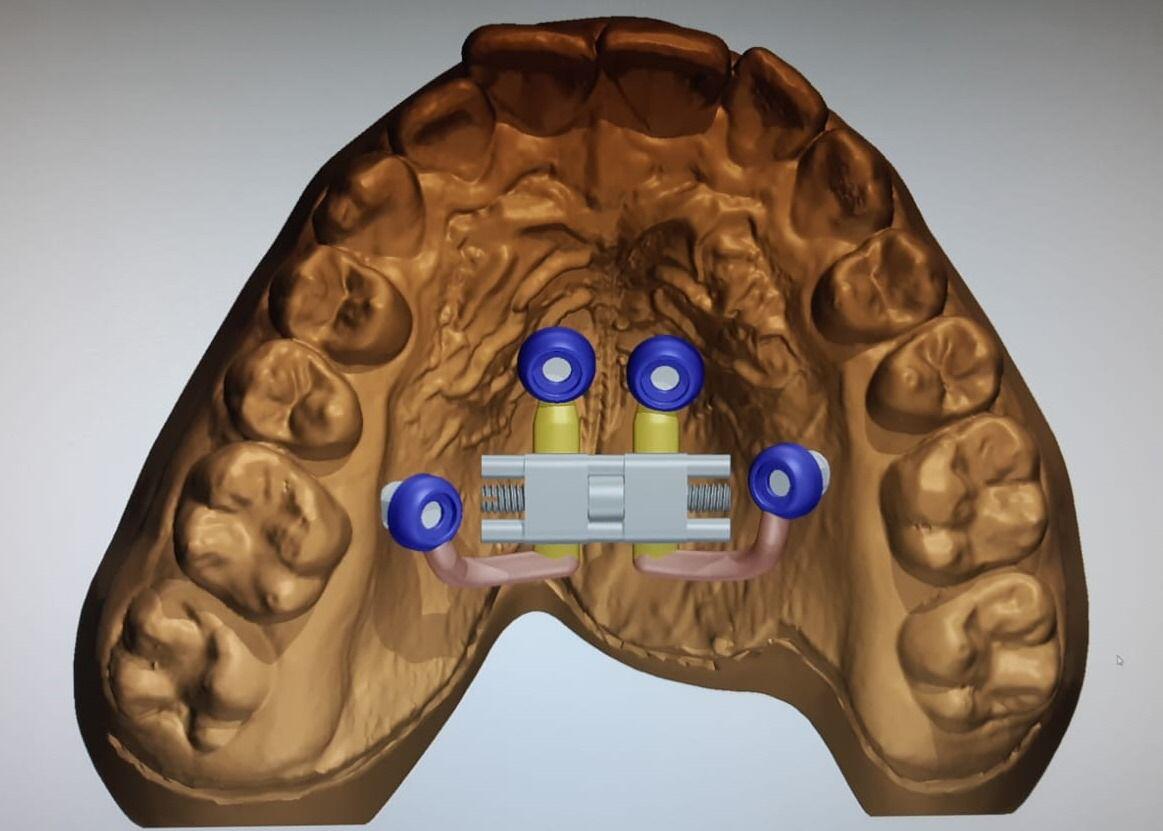 Espansione rapida del palato assistita negli adulti: una sola seduta e ...